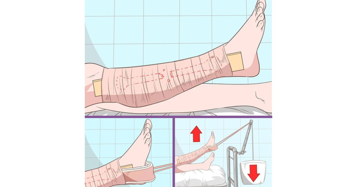 Skin traction kit DELUXE | Δίγκας Γ. Ιατρικά