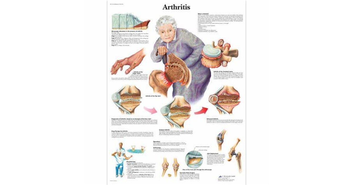 Arthritis poster | Δίγκας Γ. Ιατρικά